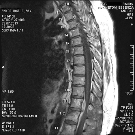 近期胸前血肿血肿与后创伤性T11-12椎间盘突出：案例报告